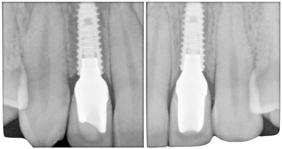 Presenting a Protocol for Dental Implant Restorations