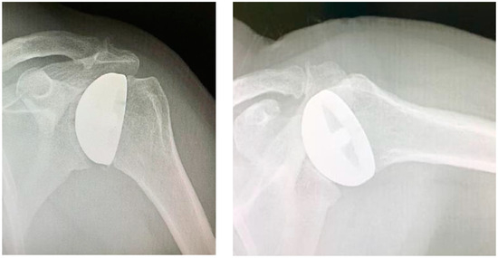 Humeral Resurfacing Arthroplasty: Clinical, Functional and Radiological ...