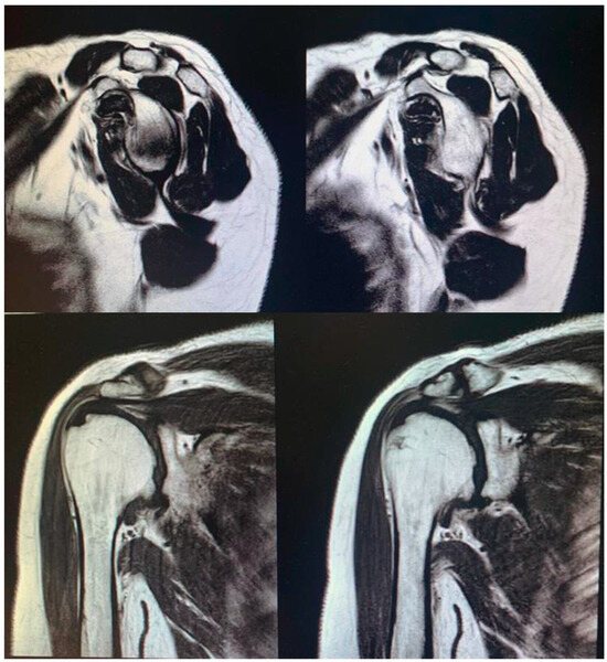 Humeral Resurfacing Arthroplasty: Clinical, Functional and Radiological ...