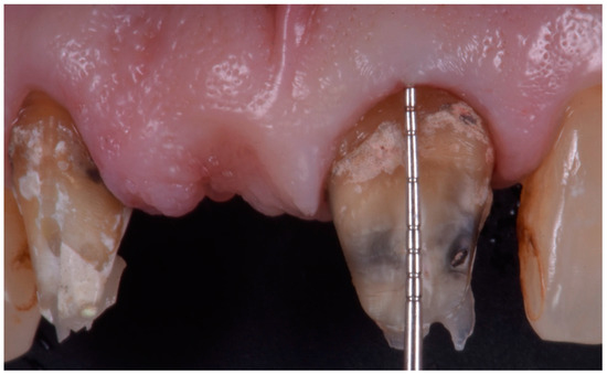 Emergence Profile Creation with CAD Technology on Vertical Edgeless ...