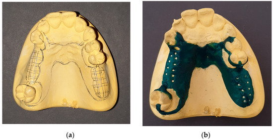 Aesthetics in Removable Partial Dentures: Modification of the Proximal ...