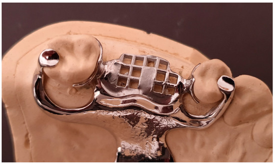 Aesthetics in Removable Partial Dentures: Modification of the Proximal ...