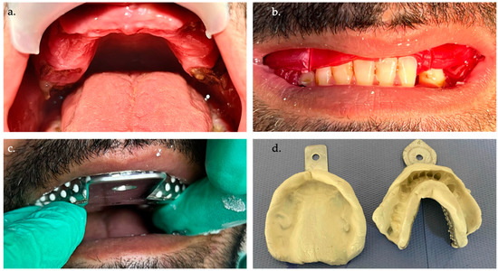 Innovating Prosthodontic Rehabilitation: A Streamlined Two-Step ...