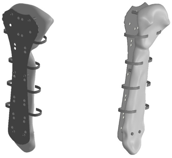Design of a Compliant Sternum Prosthesis for Improving Respiratory Dynamics