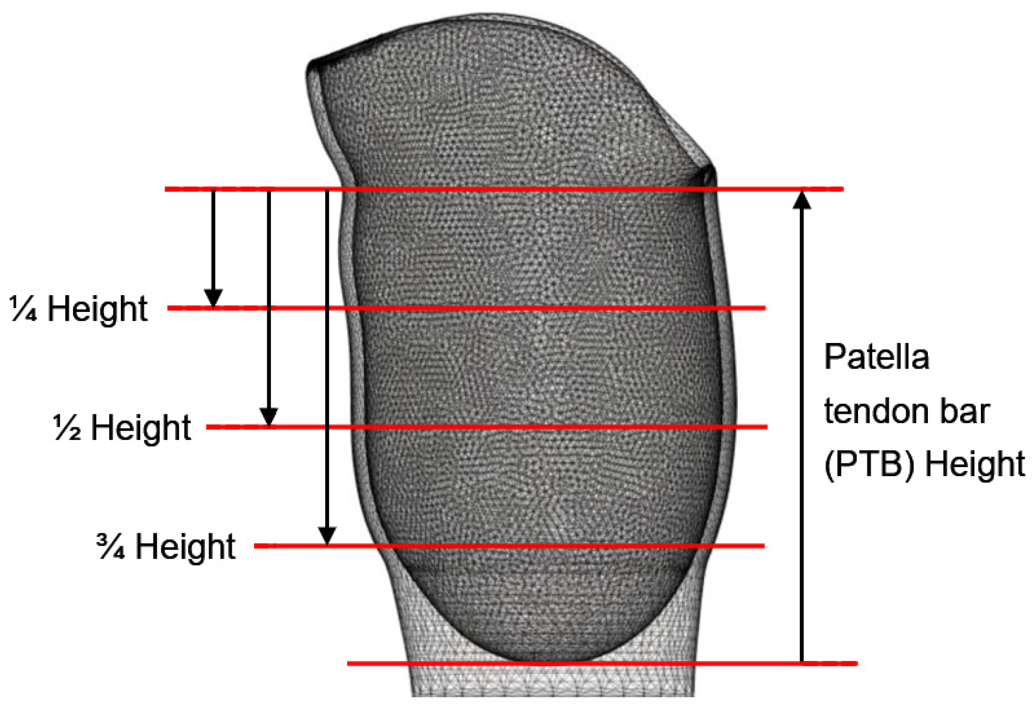 Comparison of Socket Geometry, Socket Comfort, and Patient Experience ...