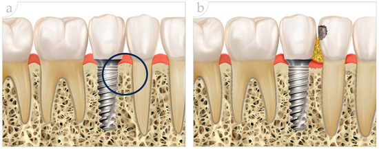 Clinical Effects of Interproximal Contact Loss between Teeth and ...