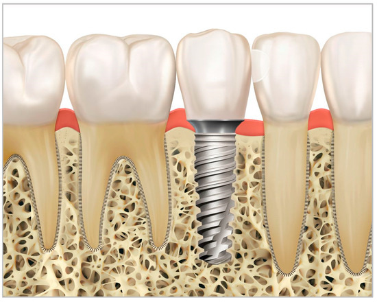Clinical Effects of Interproximal Contact Loss between Teeth and ...