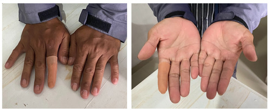 Prosthesis | Free Full-Text | Color Modification of Silicone-Based ...