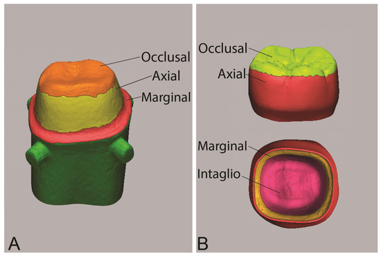 Accuracy and Fit of Ceramic Filled 3D-Printed Resin for Permanent Crown ...