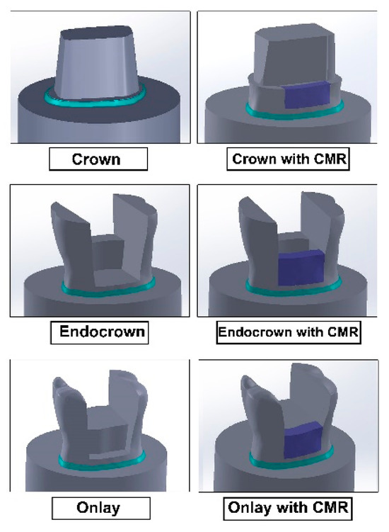 Cervical Margin Relocation: Effect of Crown, Endocrown and Onlay Margin ...