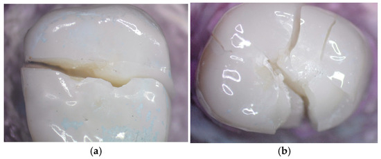 Cervical Margin Relocation: Effect of Crown, Endocrown and Onlay Margin ...