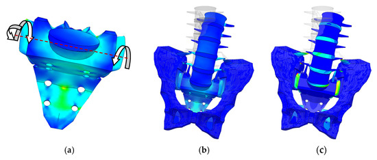 Biomechanical Analysis of Stress–Strain Distribution in the Lumbar ...