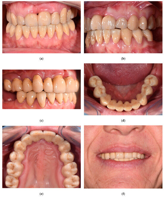 Adaptation Skills and Temporomandibular Joint Neutrality: A Case Report ...