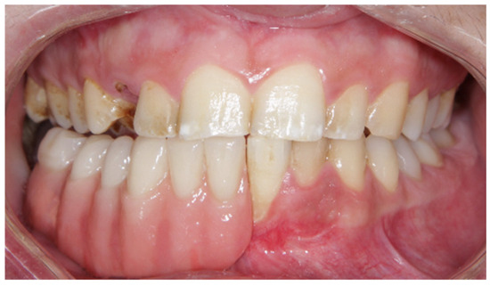 Implant Prosthetic Rehabilitation in a Mandible Osteosarcoma Patient: A ...