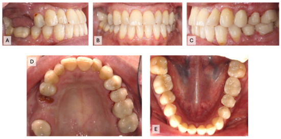 A Milled-Provisional Crown with Attachment: A Novel Prosthodontic ...