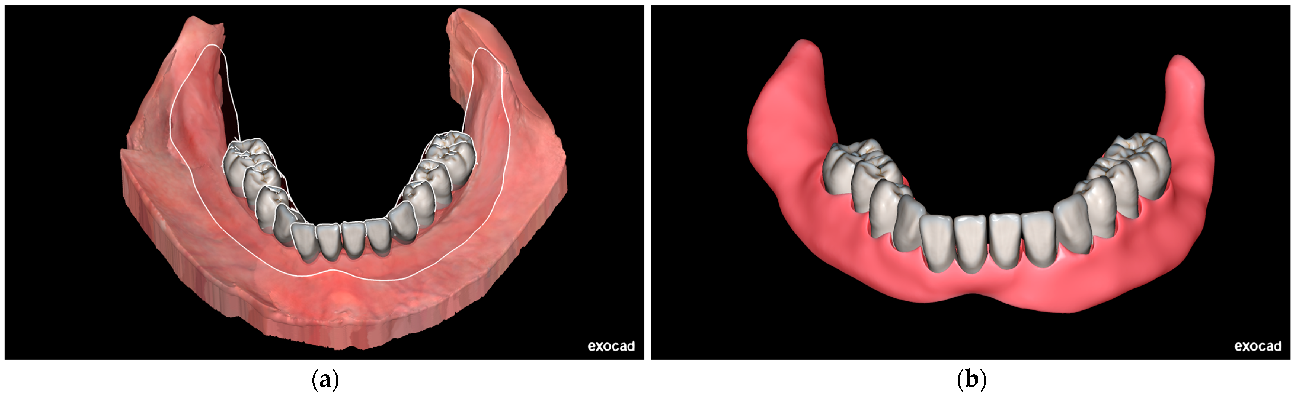 Enhanced Retention of Mandibular Digital Complete Dentures Using an ...