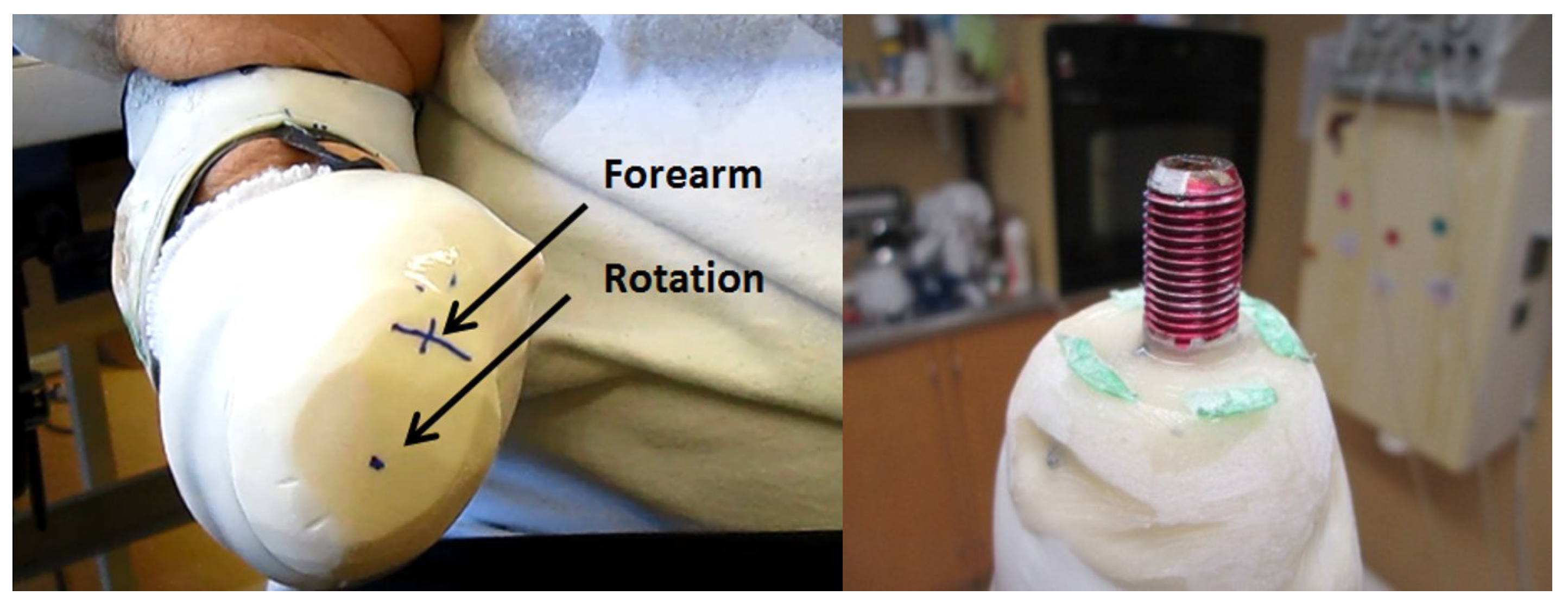 Novel Design of a Transradial Socket to Allow Independent Pro ...