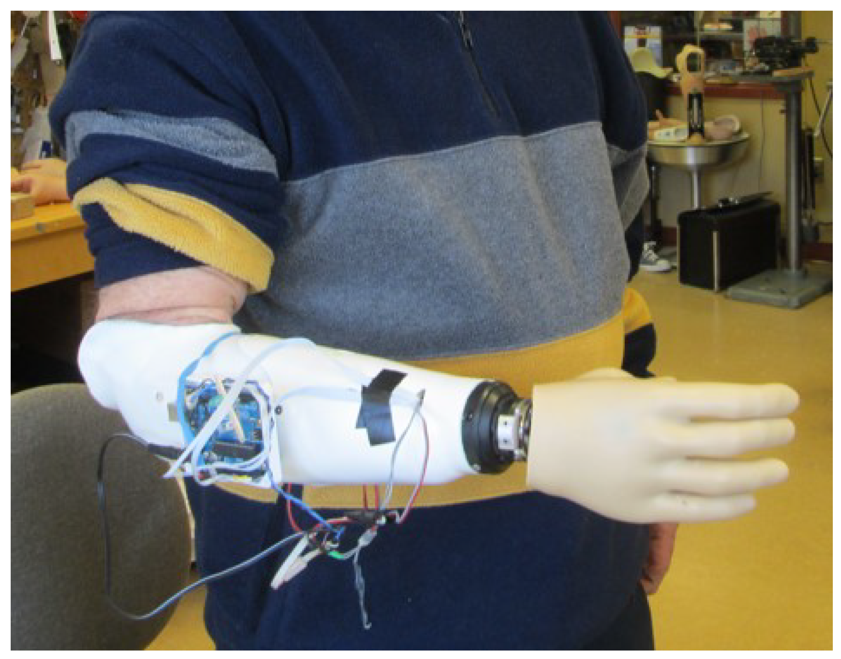 Novel Design of a Transradial Socket to Allow Independent Pro ...