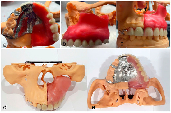 Design Process and Early Functional Outcomes of Digitally Planned ...