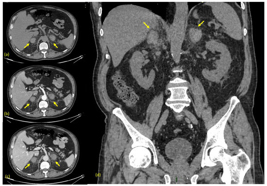 Multimodality Imaging Findings in Waterhouse-Friderichsen Syndrome: A ...