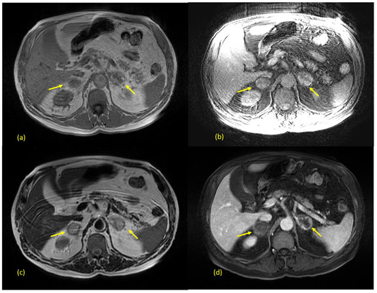 Multimodality Imaging Findings in Waterhouse-Friderichsen Syndrome: A ...