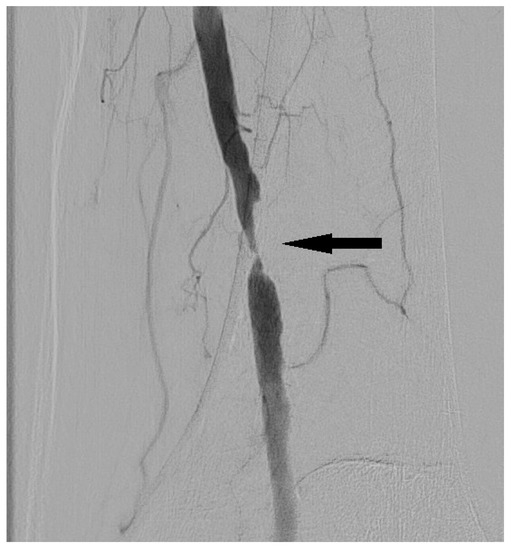 Digital Subtraction Angiography (DSA) Technical and Diagnostic Aspects ...
