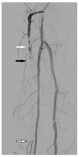 Digital Subtraction Angiography (DSA) Technical and Diagnostic Aspects ...