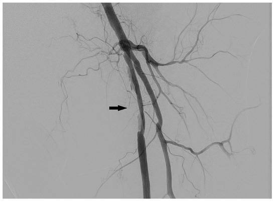 Digital Subtraction Angiography (DSA) Technical and Diagnostic Aspects ...