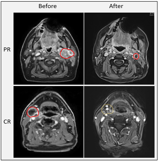 Deep Texture Analysis Enhanced MRI Radiomics for Predicting Head and ...