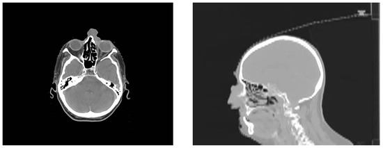 Radiation | Free Full-Text | An “Older Old” Woman with Large Squamous ...
