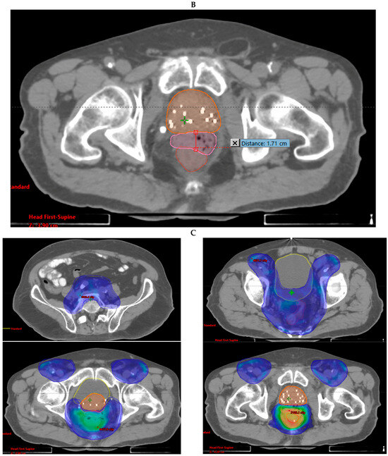 Rectal Spacer Placement for Anorectal Reirradiation of De Novo Rectal ...