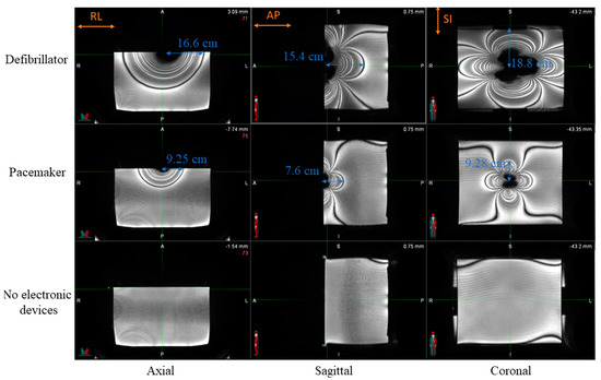 The Effect of Pacemakers and Defibrillators on Distortion in 2 Magnetic ...