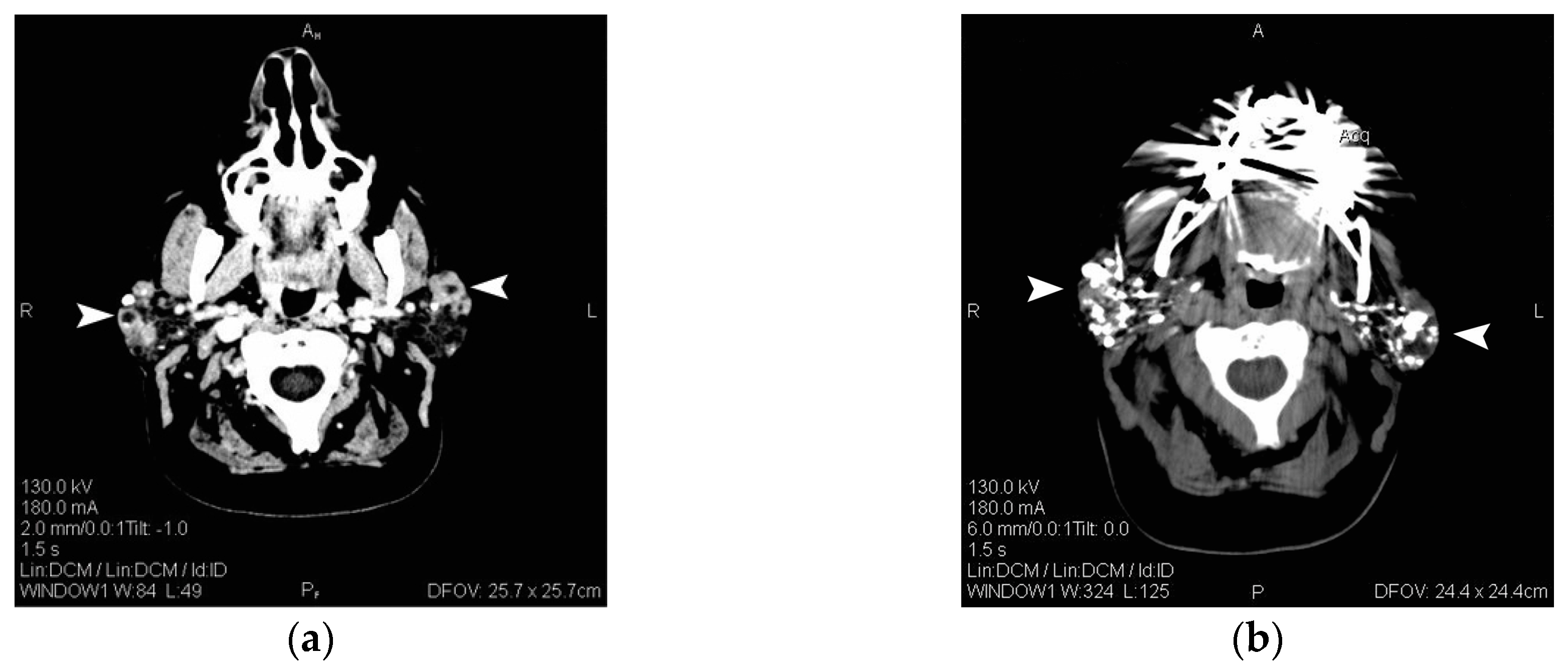 Imaging Study of Pseudotumoral Chronic Sialadenitis with Cystic-Like ...