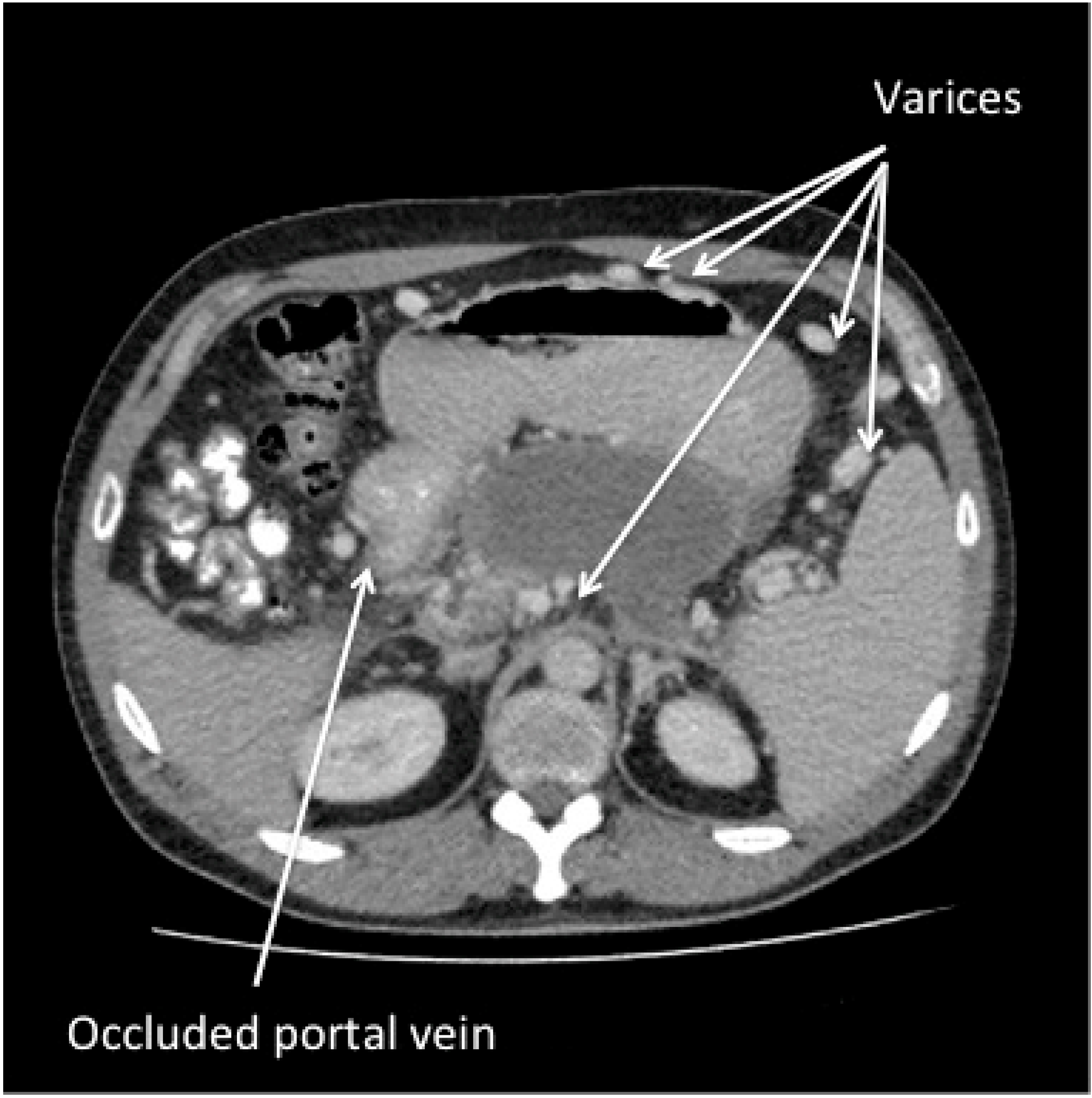 Gastric Varices Ct