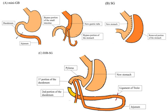 Impacts of Different Modes of Bariatric Surgery on Plasma Levels of ...