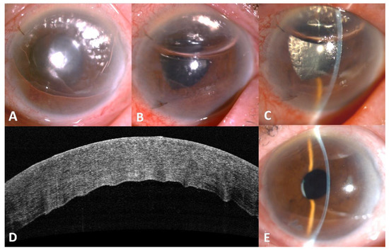Management of Descemet’s Membrane Detachment after Cataract Surgery—A ...