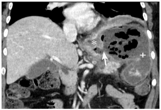 Gastro-Splenic Fistula Related to Large B Cell Lymphoma