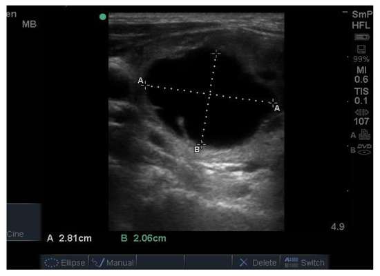 Ultrasonographic Findings in Common Thyroid and Parathyroid Disorders ...