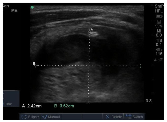 Ultrasonographic Findings in Common Thyroid and Parathyroid Disorders ...