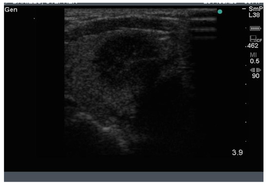 Ultrasonographic Findings in Common Thyroid and Parathyroid Disorders ...