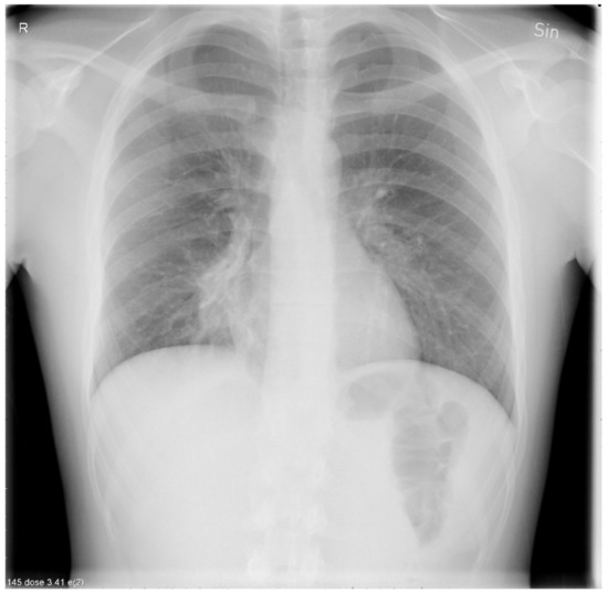 Reactive Infectious Mucosal Eruptions (RIME) Secondary to Chlamydia ...