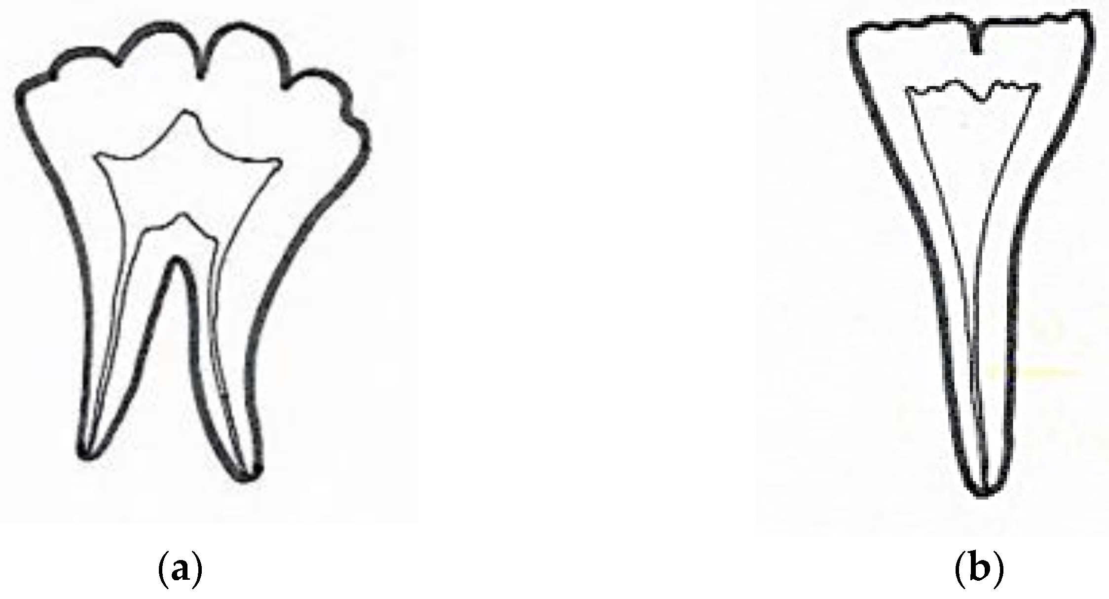 A Geminated Mandibular Second Molar—A Case Report