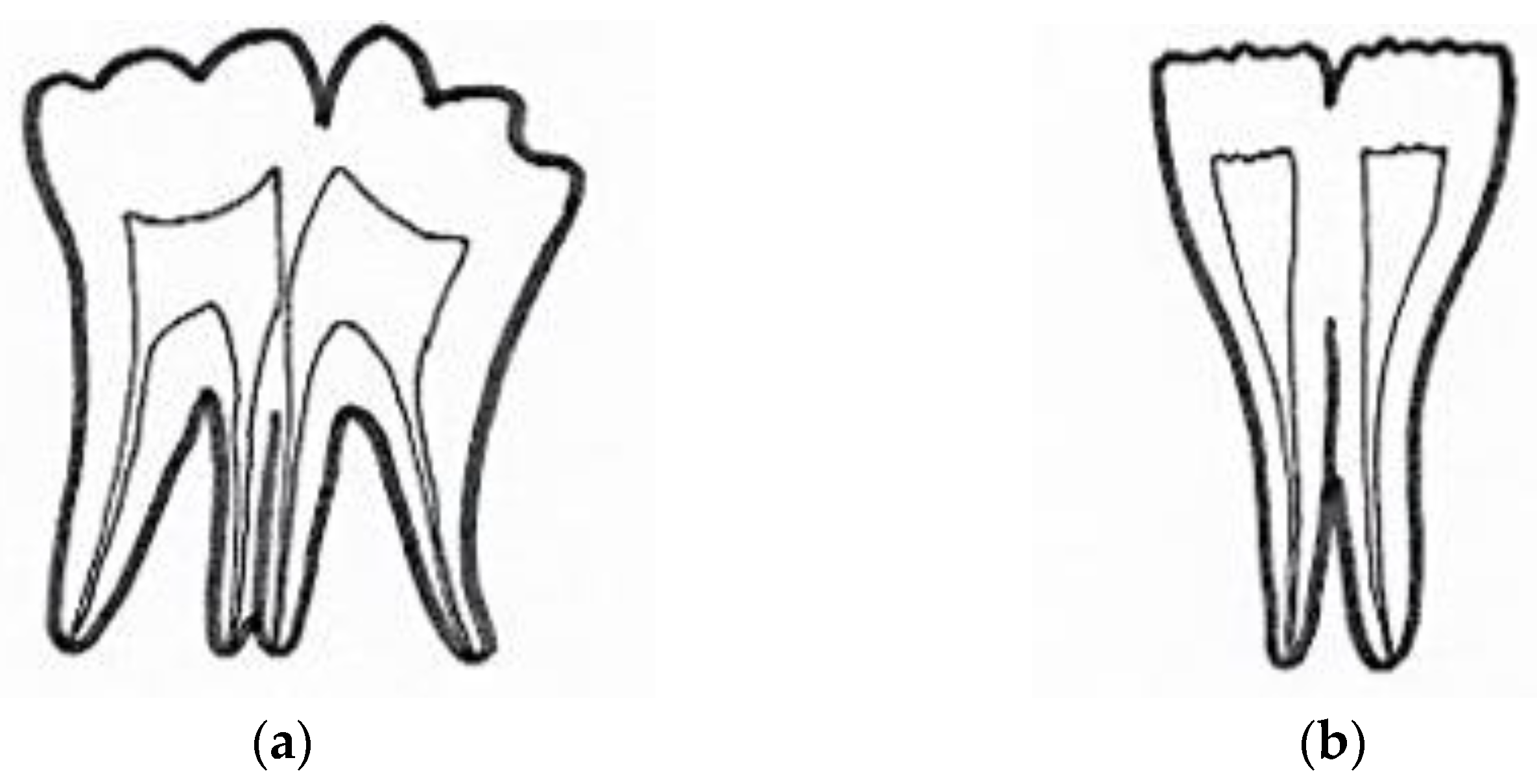 A Geminated Mandibular Second Molar—A Case Report