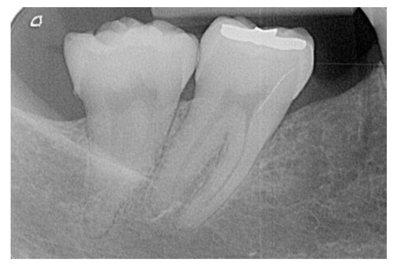 A Geminated Mandibular Second Molar—A Case Report