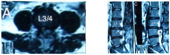 Reports | Free Full-Text | Intradural Lumbar Disc Herniation: Updated ...