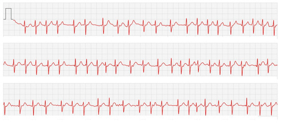 Apple Watch for Pulse Rate Assessment Detects Unidentified Paroxysmal ...