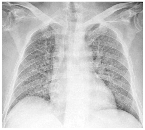 Fatal Case of Autochthonous Strongyloides stercoralis Hyperinfection in ...