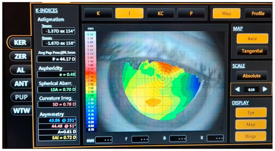 Evaluation of Ocular Biometric Parameters Following Cataract Surgery