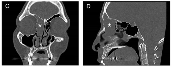 A Combined Surgical Approach for the Treatment of a Sino-Naso-Orbital ...
