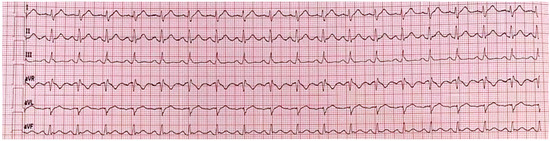 Paroxysmal Atrial Fibrillation with Rapid Ventricular Response Following COVID-19 Nasopharyngeal ...